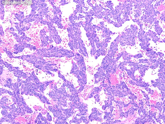 Type A Thymoma: Differential Diagnosis