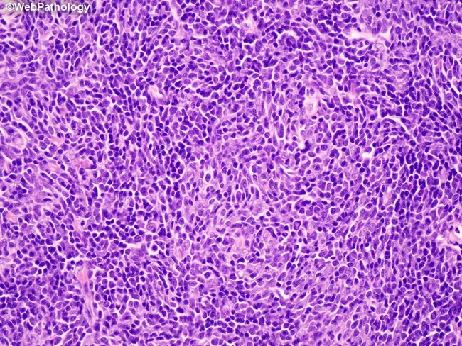 Type AB Thymoma