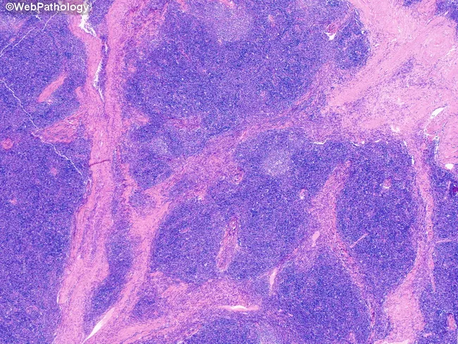 Type B1 Thymoma: Microscopic Features