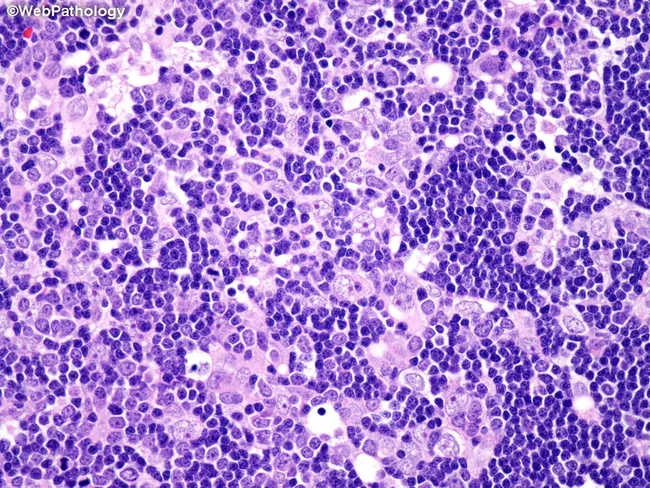Type B1 Thymoma: Microscopic Features