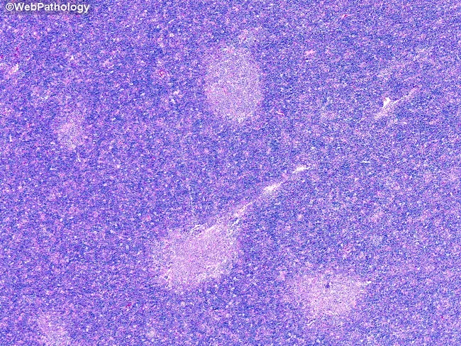Type B1 Thymoma: Microscopic Features