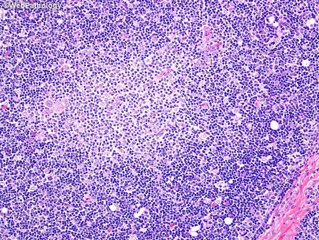 Type B1 Thymoma: Microscopic Features