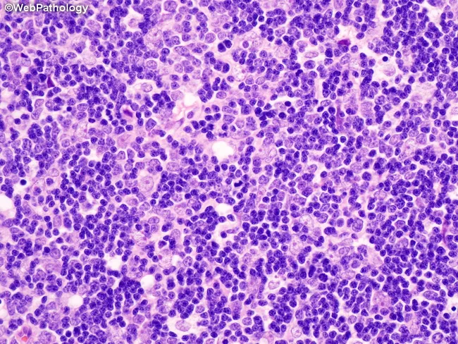 Type B1 Thymoma: Differential Diagnosis