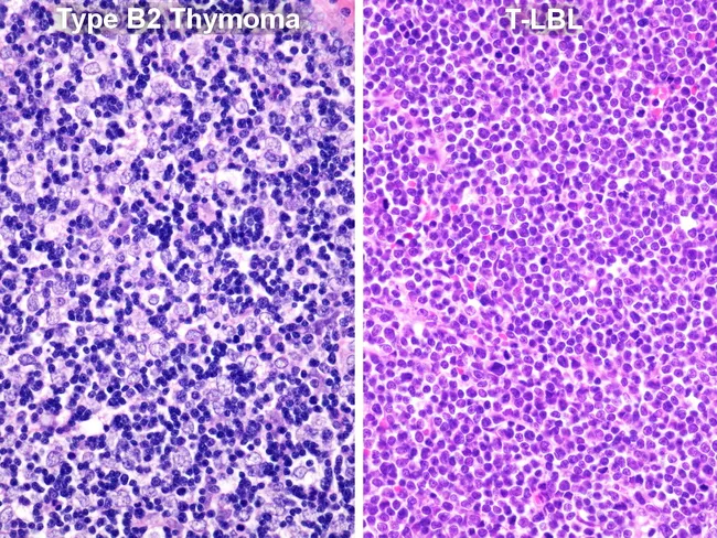 Type B2 Thymoma: Differential Diagnosis