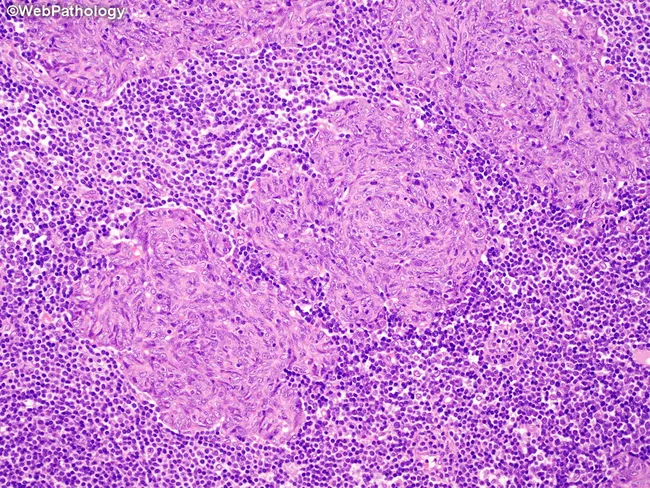 Micronodular Thymoma with Lymphoid Stroma: Differential Diagnosis