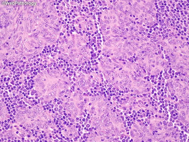 Micronodular Thymoma with Lymphoid Stroma: Prognosis