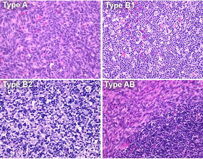 Thymoma: Classification