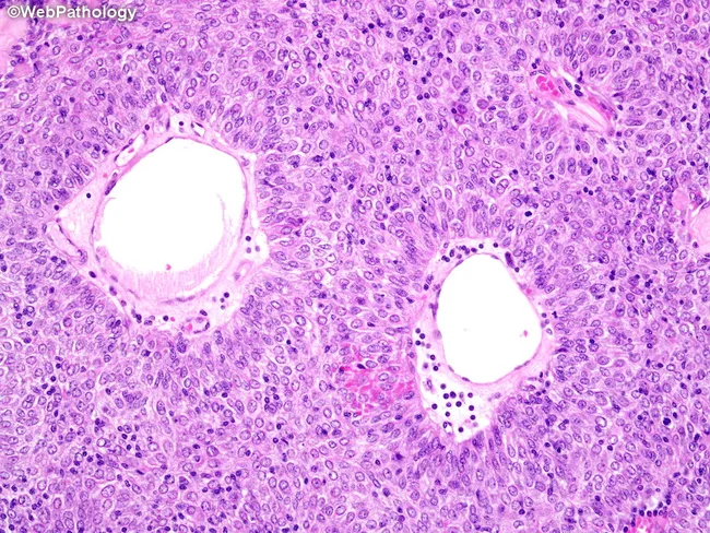 Thymoma Type B3 (Epithelial; Atypical)