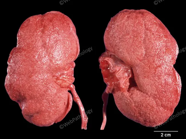 Renal Medicine Hull