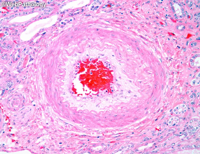 Benign Nephrosclerosis: Microscopic Features