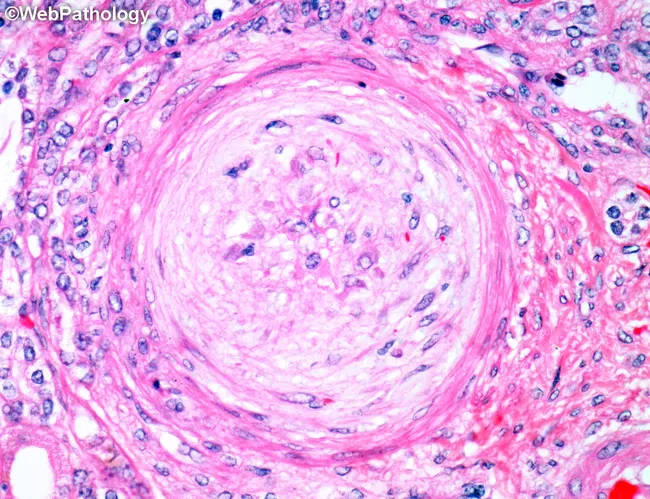 Benign Nephrosclerosis: Microscopic Features