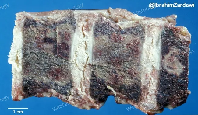 Angiosarcoma of Bone