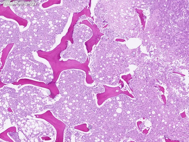 Epithelioid Angiosarcoma of Bone