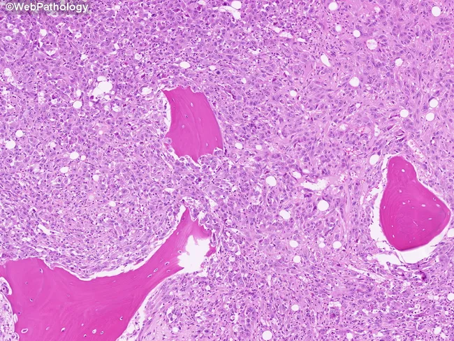 Epithelioid Angiosarcoma of Bone