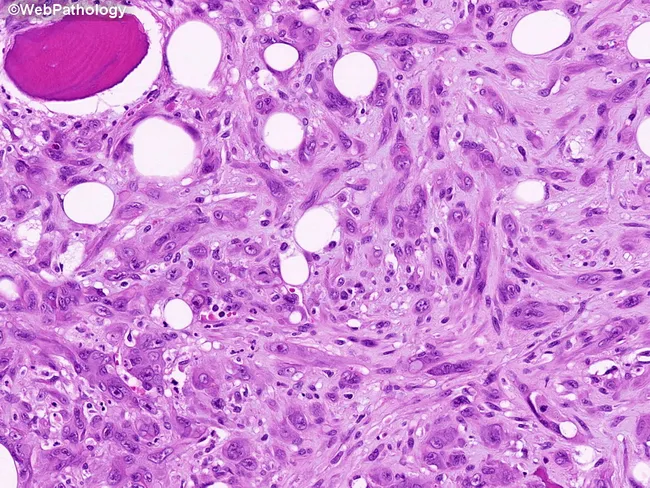 Epithelioid Angiosarcoma of Bone