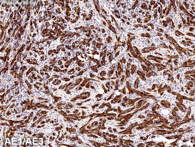 Epithelioid Angiosarcoma of Bone: AE1/AE3